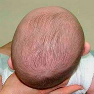 My baby has a flat head – what can i do about Positional Head Deformity ...